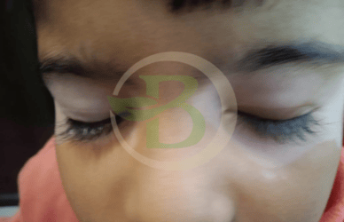 Homeopathic Treatment for white patches on skin